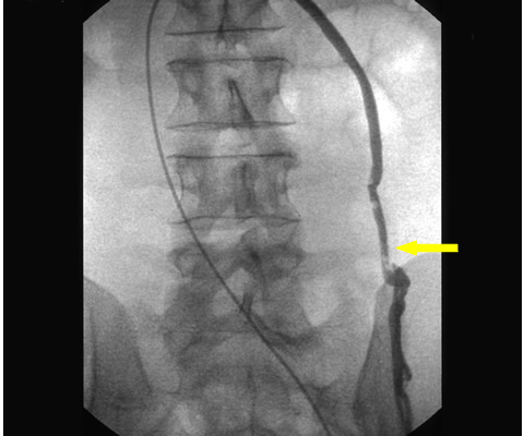 Varicocoele Embolisation