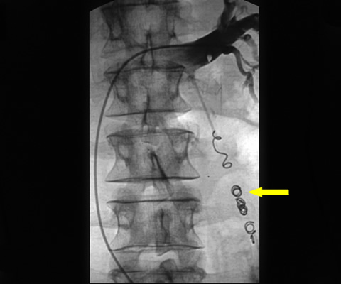 Varicocoele Embolisation