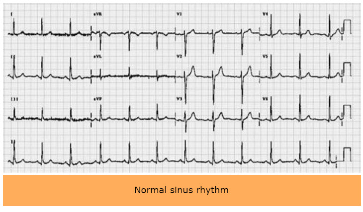 Dry Cough and Breathlessness