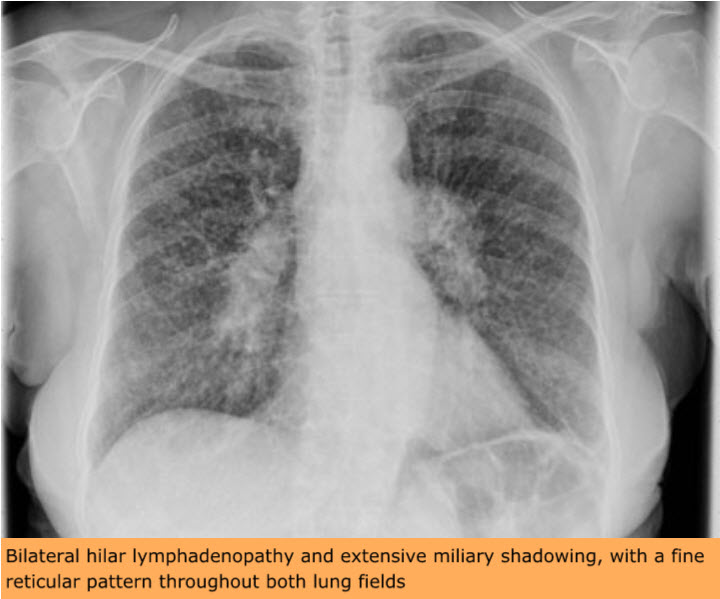 Dry Cough and Breathlessness